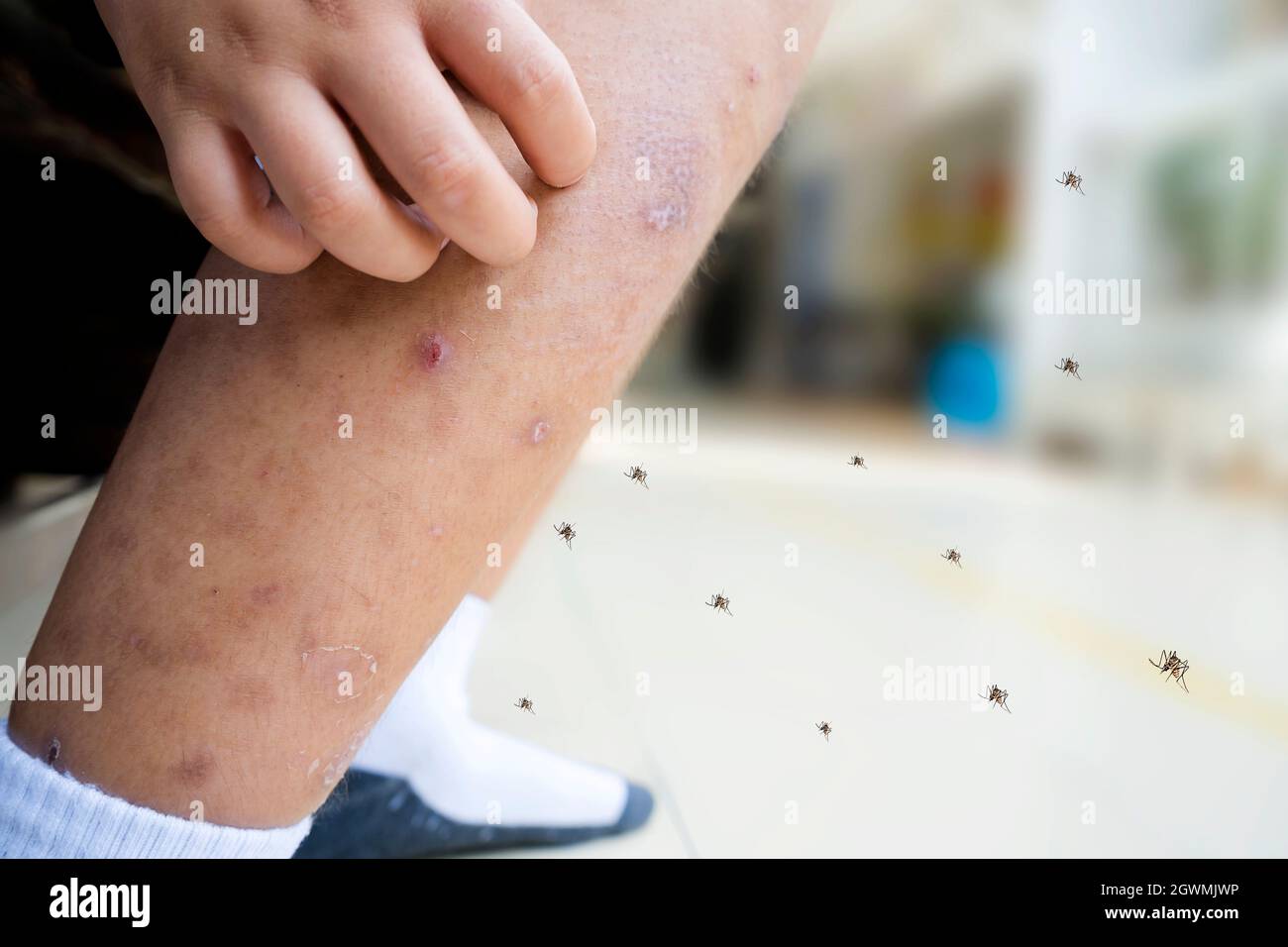 Child scratching leg hi-res stock photography and images - Alamy
