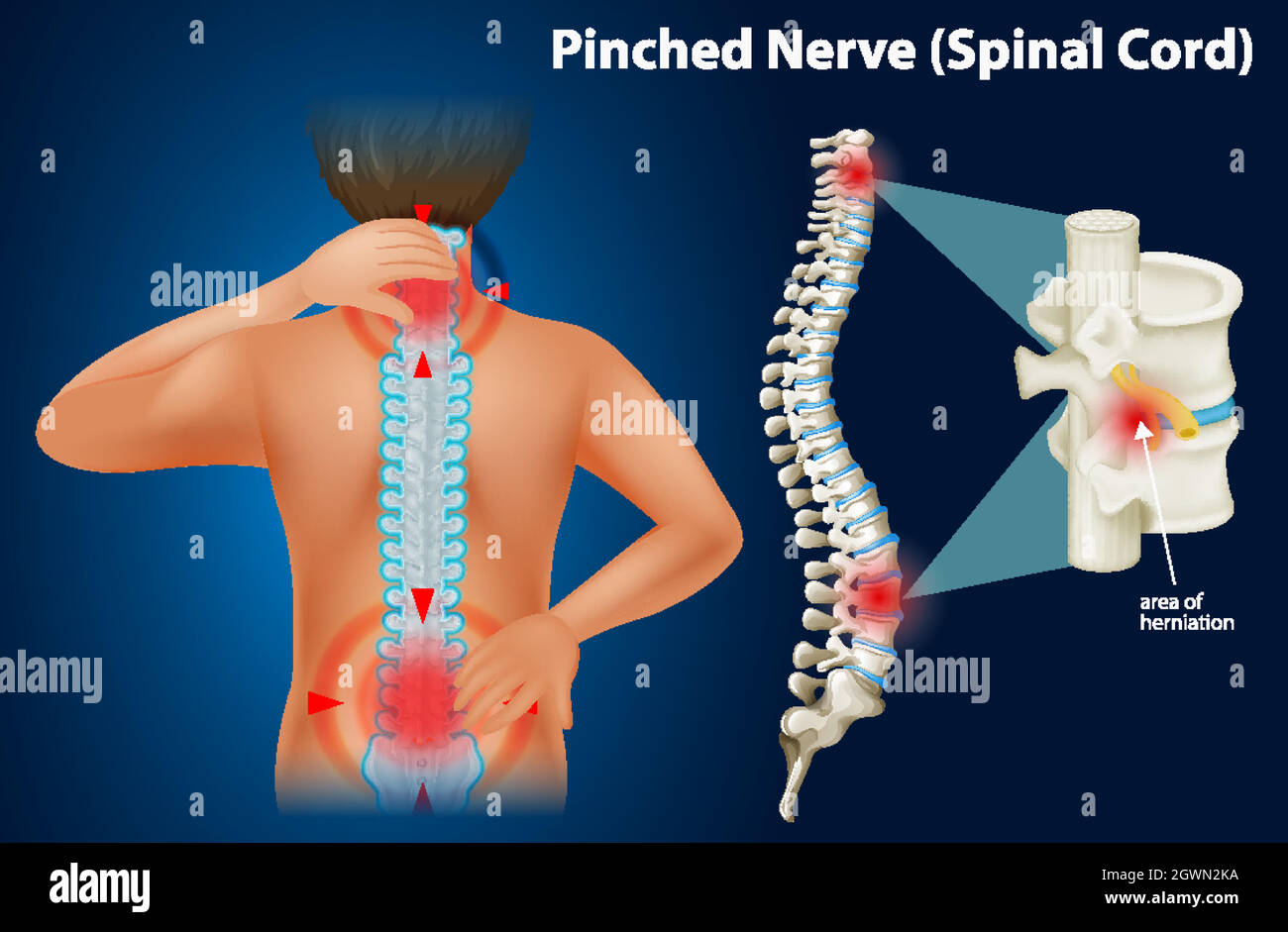 Diagram showing pinched nerve Stock Vector Image & Art - Alamy