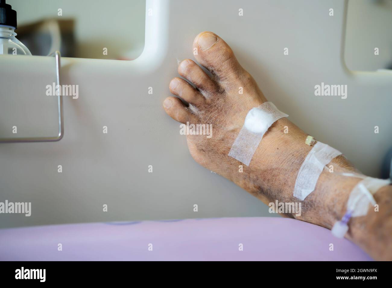 Deformed limb hi-res stock photography and images - Alamy