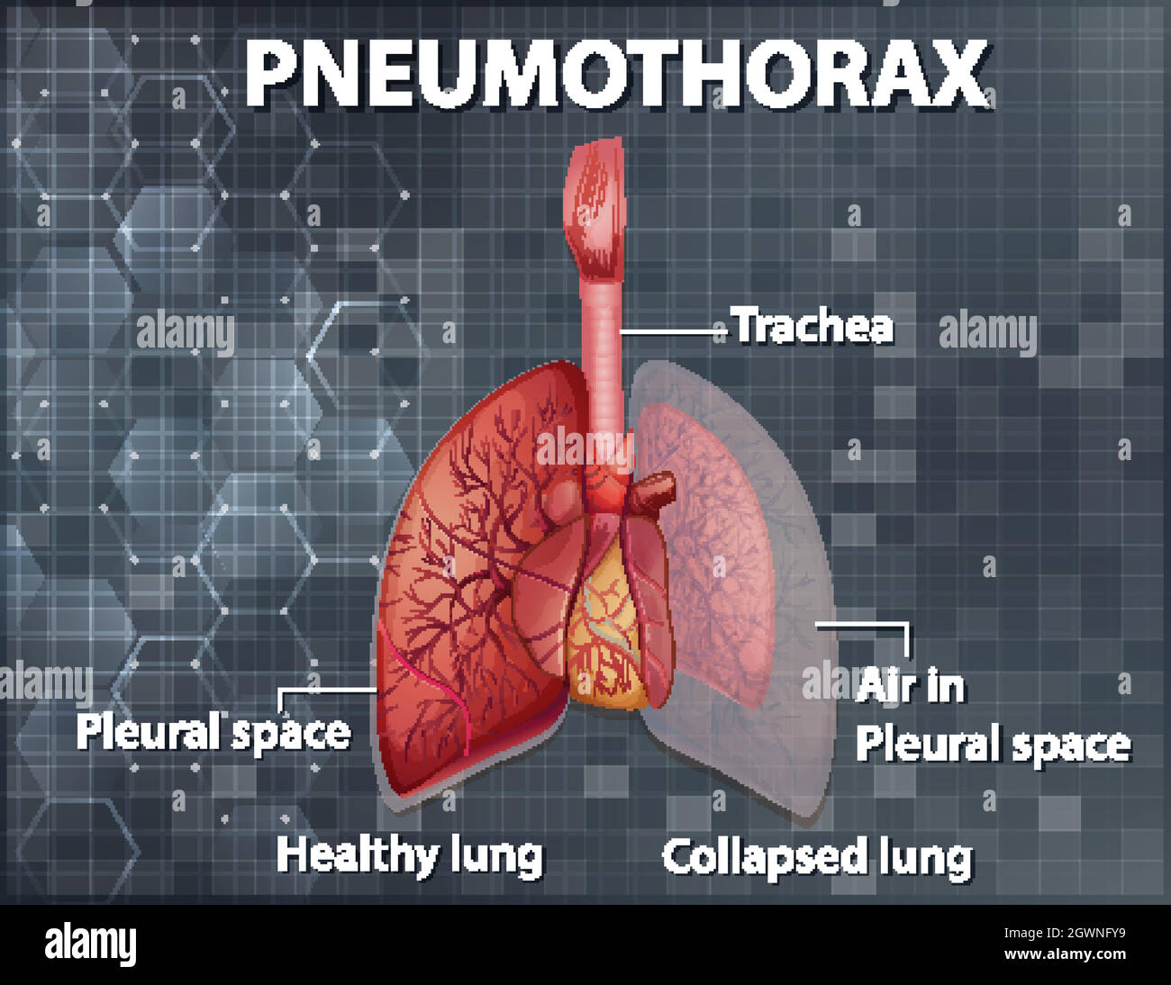 Pneumothorax hi-res stock photography and images - Alamy