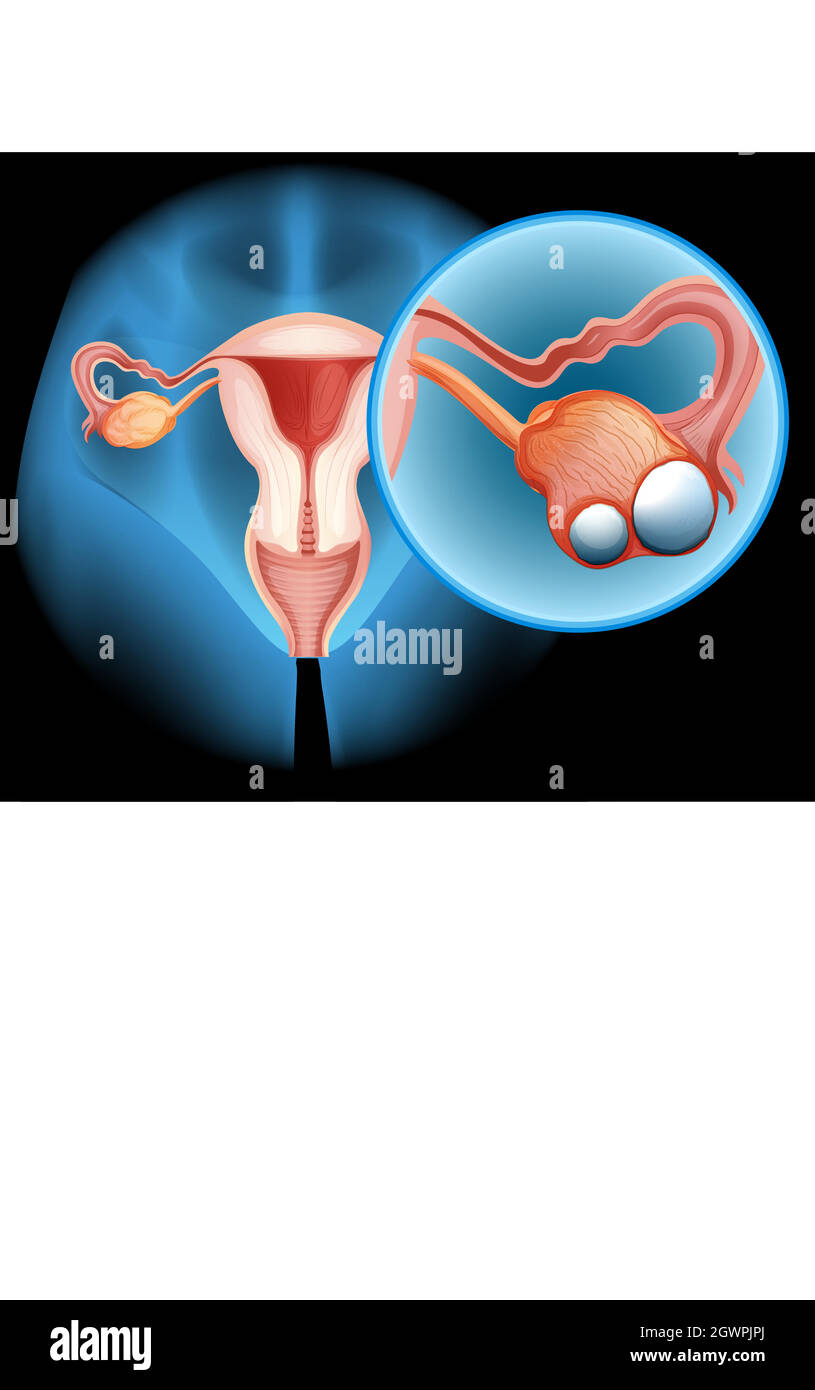 Ovarian cancer in human Stock Vector Image & Art - Alamy