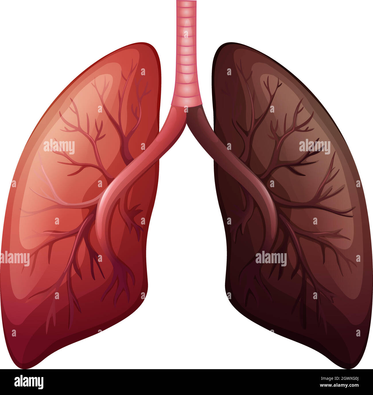 Lung Cancer Cells Diagram