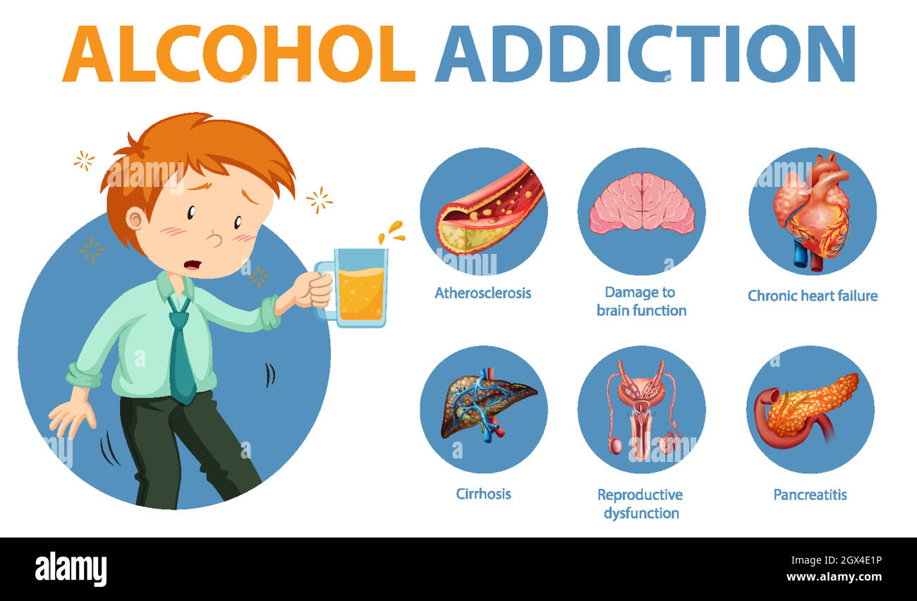 Alcohol addiction or alcoholism information infographic Stock Vector ...