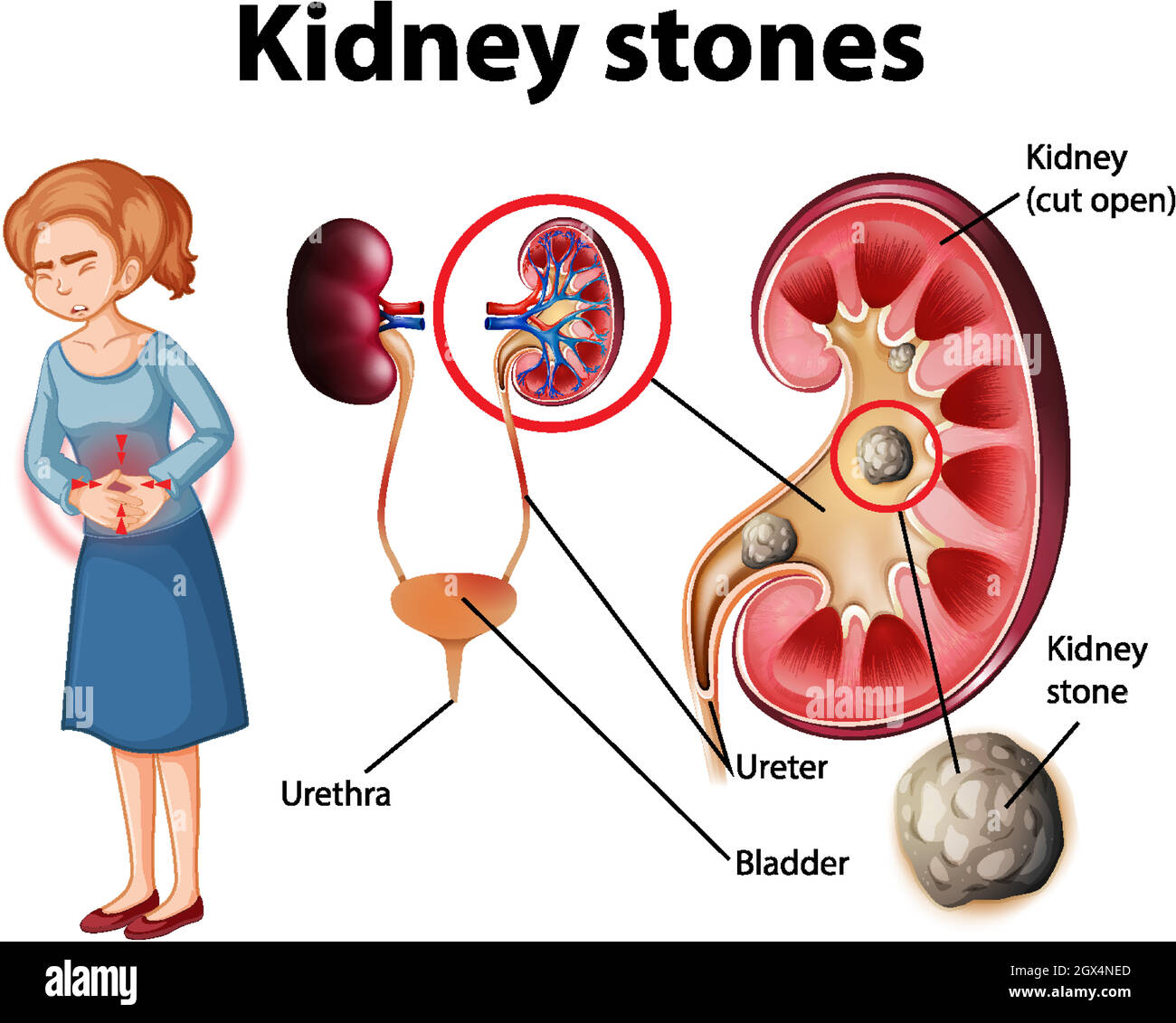 Informative illustration of kidney stones Stock Vector Image & Art - Alamy