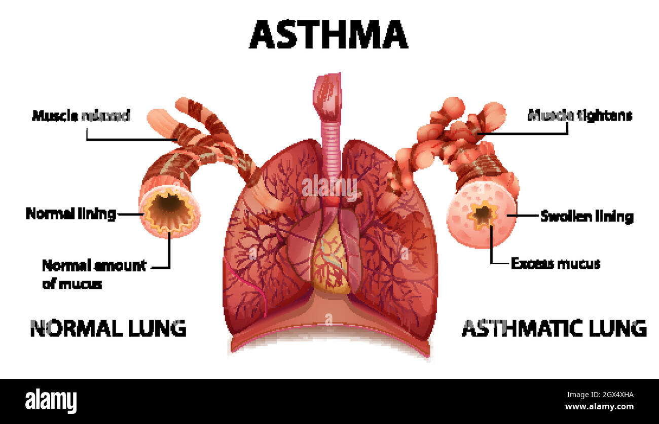 Lung asthma Stock Vector Images - Alamy