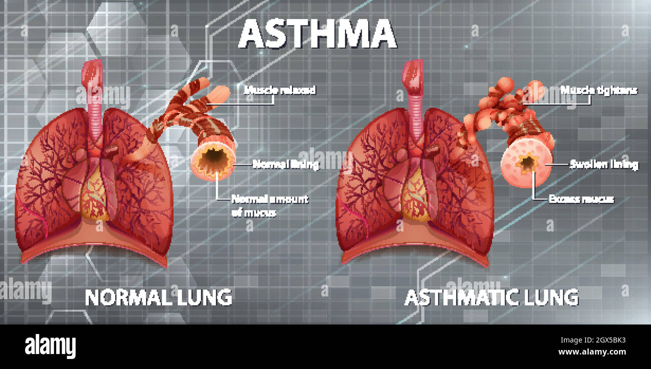 Human anatomy Asthma diagram Stock Vector Image & Art - Alamy