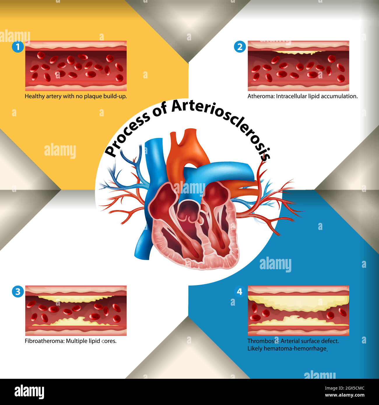 Process of Arteriosclerosis poster Stock Vector Image & Art - Alamy