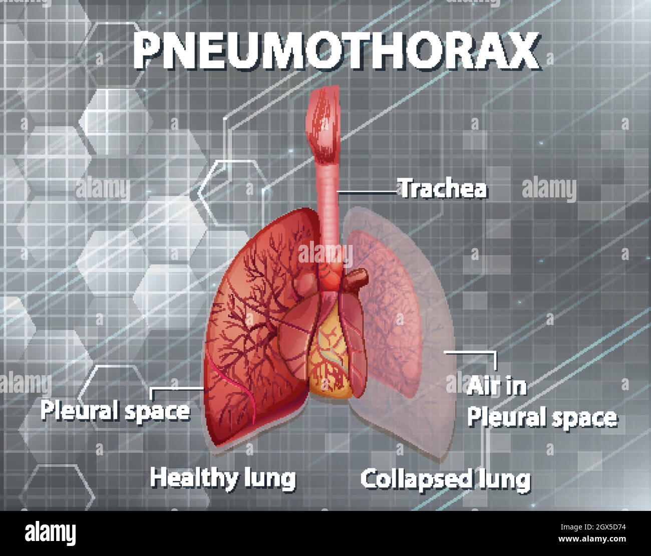Informative illustration of Pneumothorax Stock Vector Image & Art - Alamy