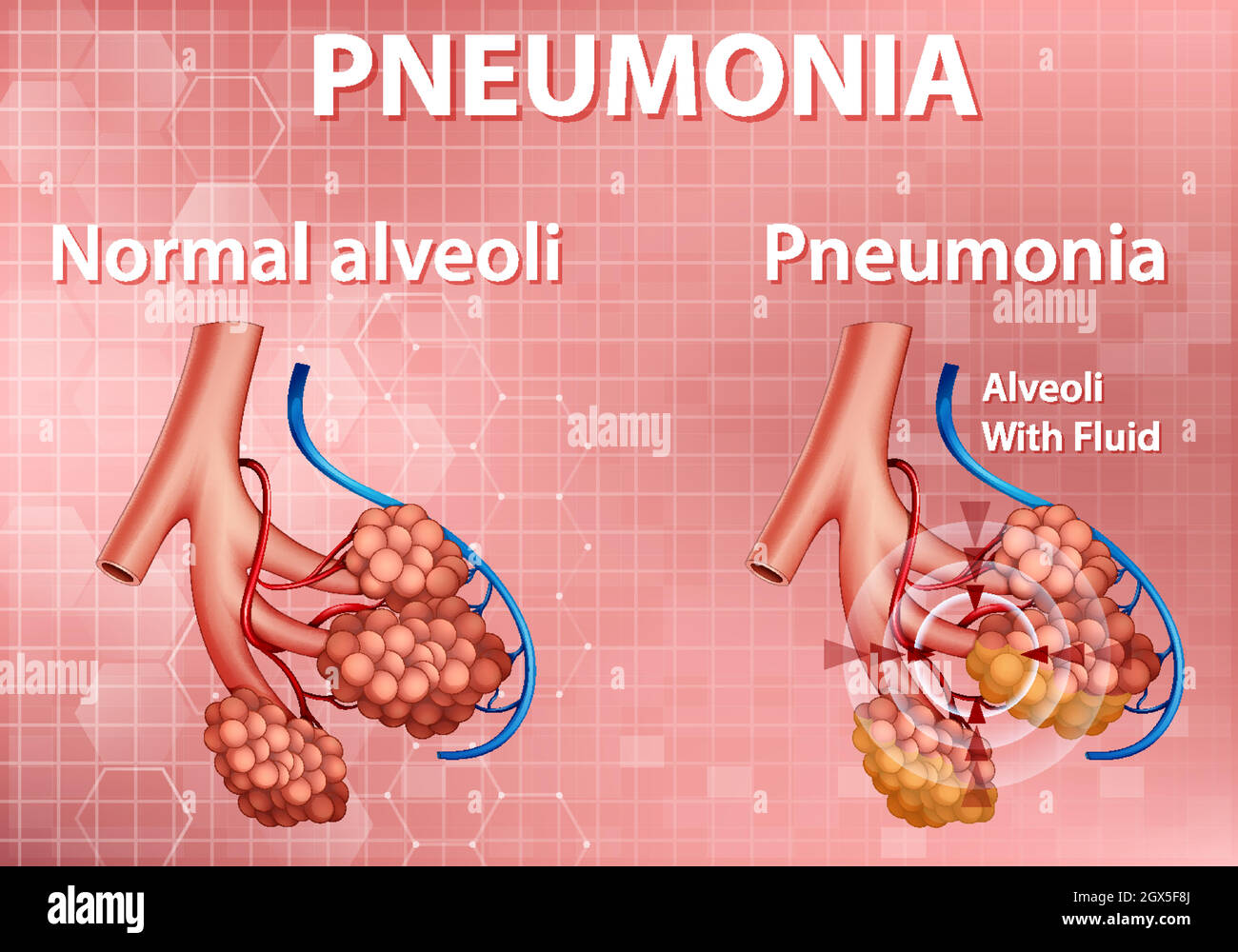 Pneumonia lung drawing hi-res stock photography and images - Alamy