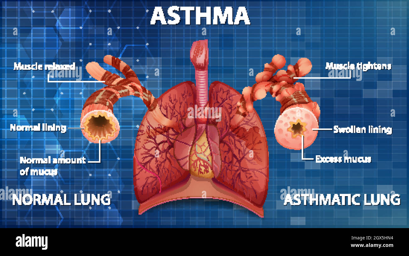 Human anatomy Asthma diagram Stock Vector Image & Art - Alamy