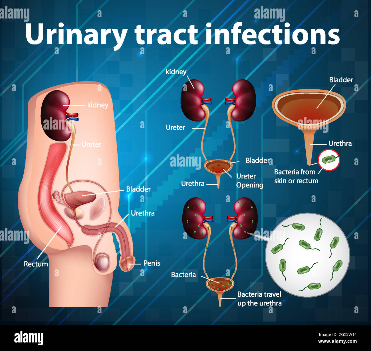 Informative Illustration Of Urinary Tract Infections Stock Vector Image