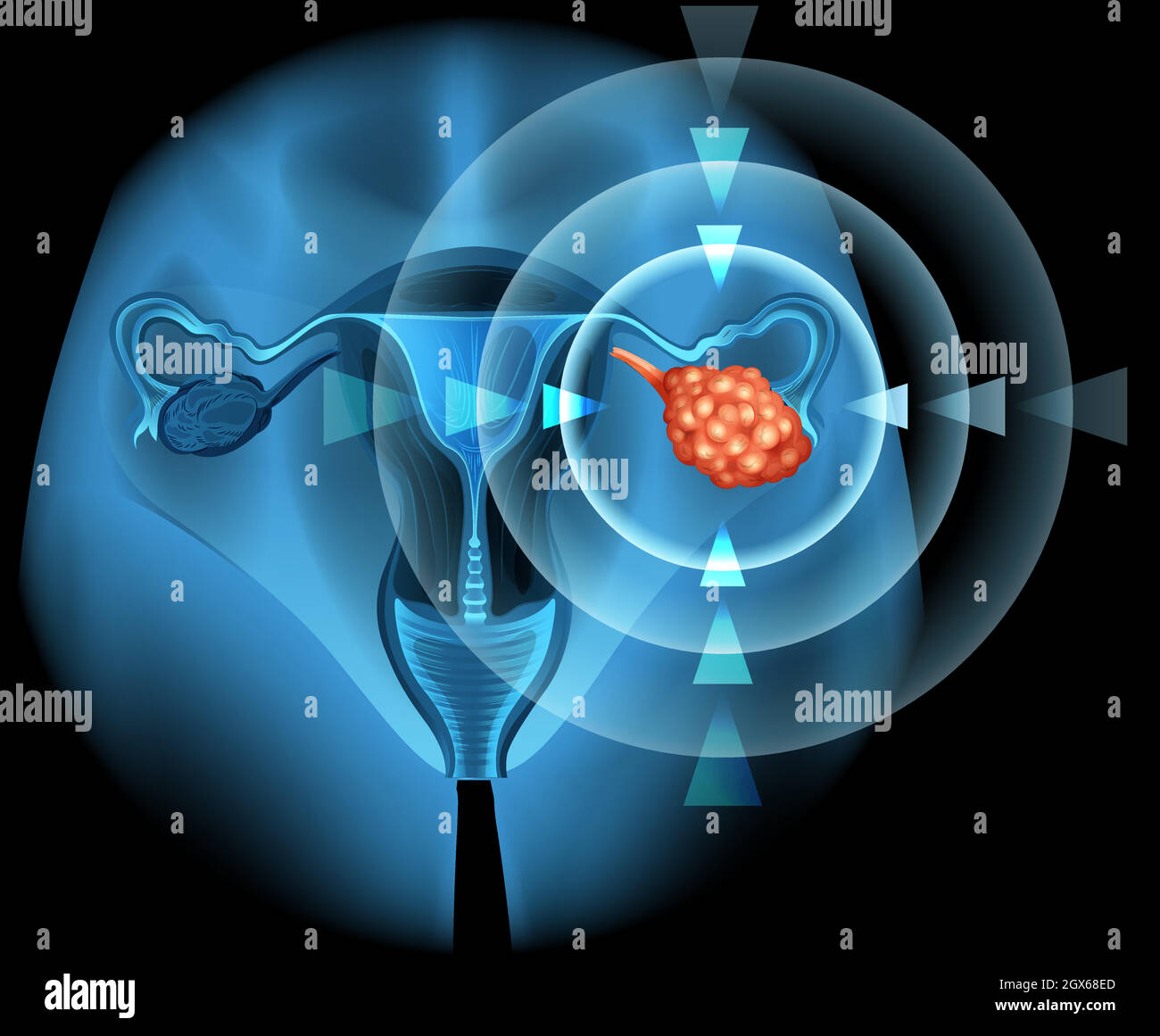 Overian cancer diagram in detail Stock Vector Image & Art - Alamy