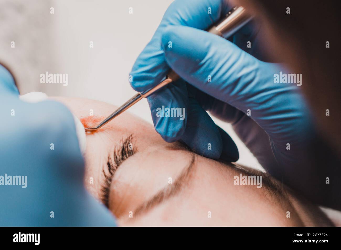 Milium on the face, removal of milia with a syringe in cosmetology. new ...