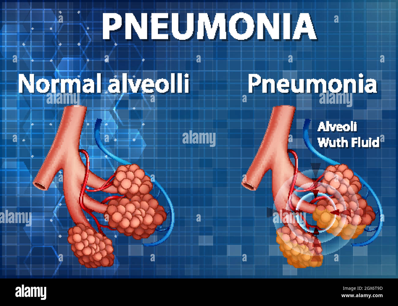 Comparison of healthy alveoli and Pneumonia Stock Vector Image & Art ...