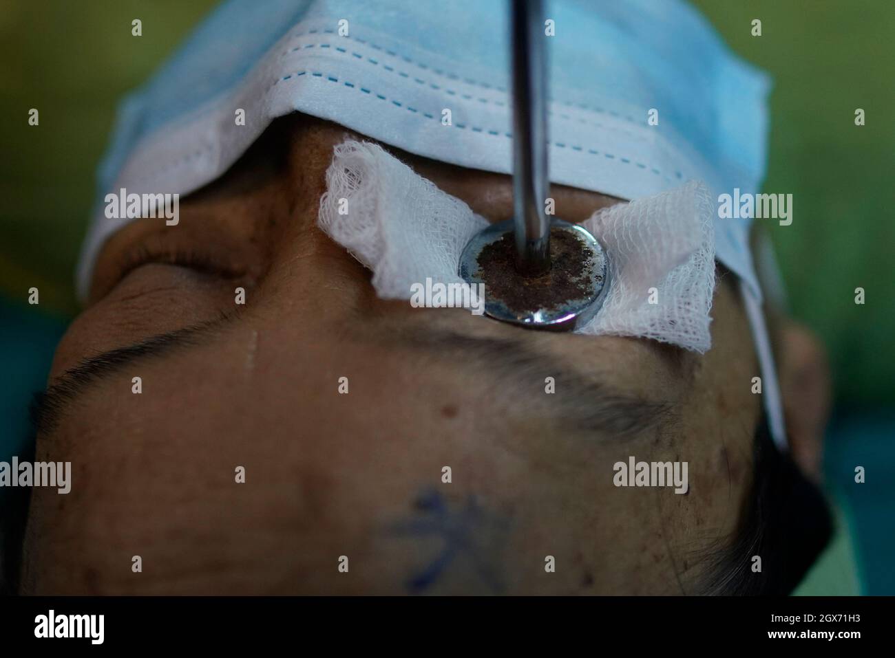 Kathmandu, Nepal. 4th Oct, 2021. A patient waits for a cataract eye ...