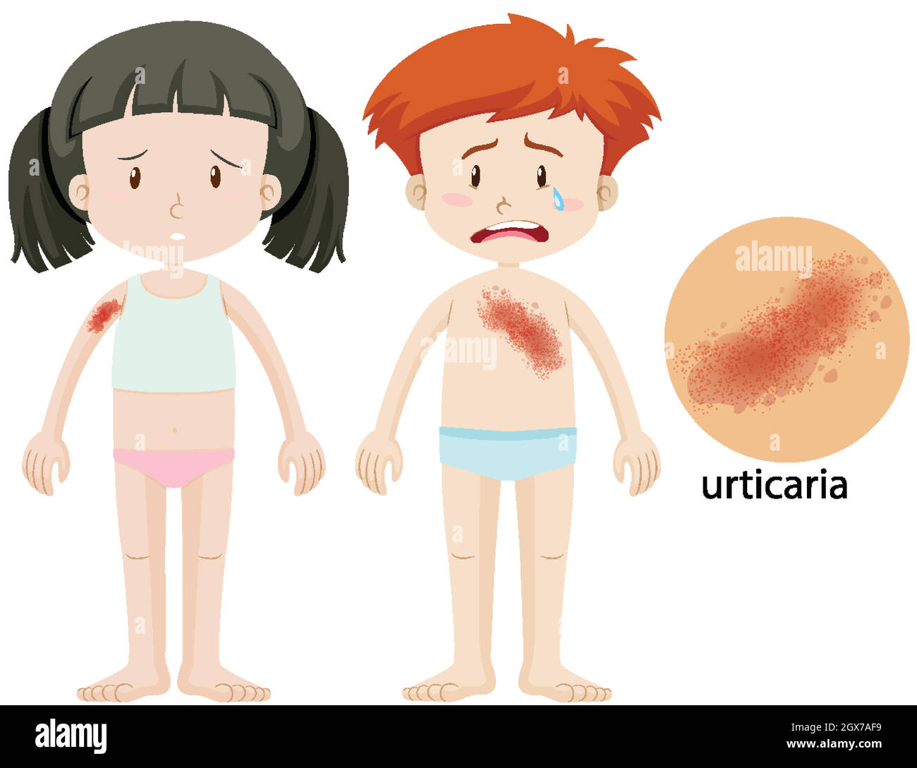 Urticaria face hi-res stock photography and images - Alamy