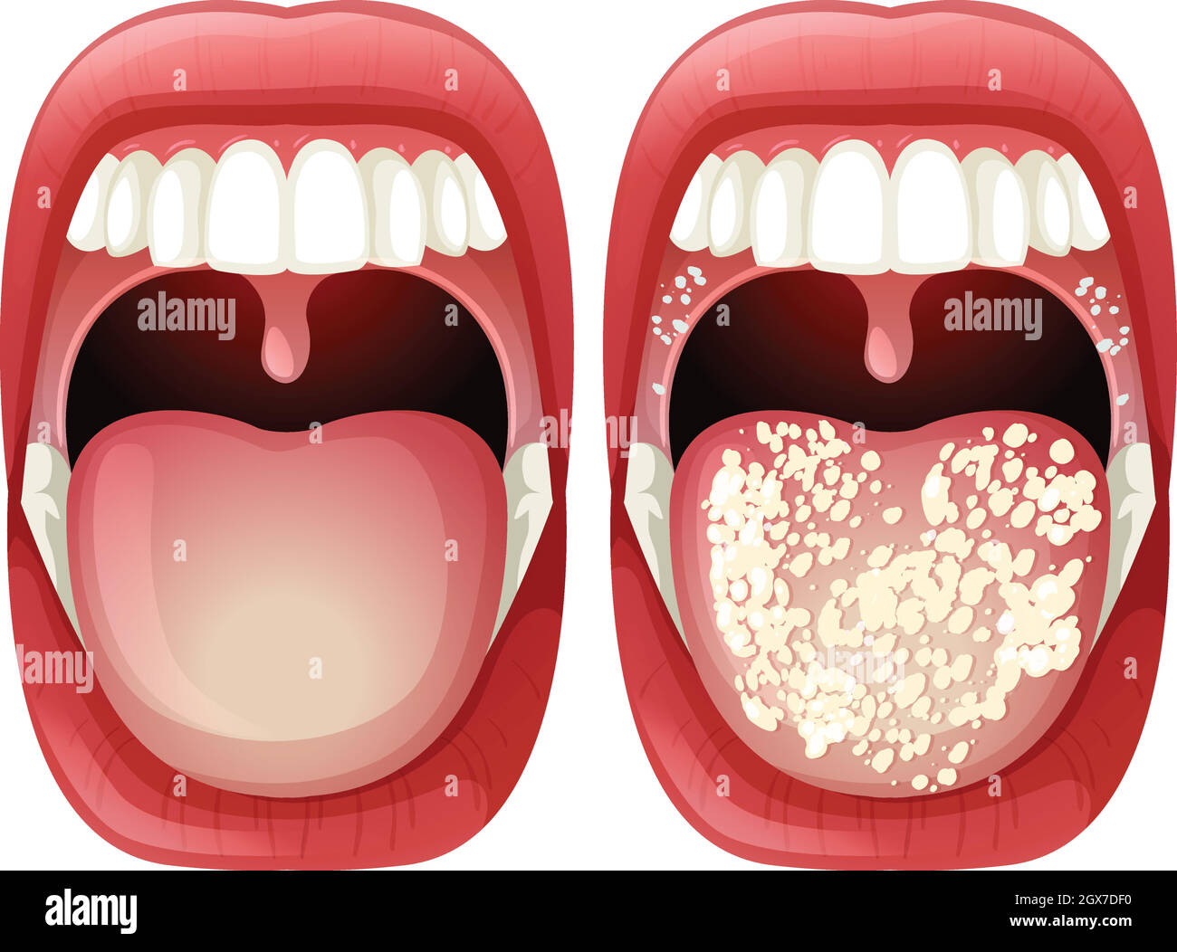 Vector of Healthy and Virus Mouth Stock Vector Image & Art - Alamy
