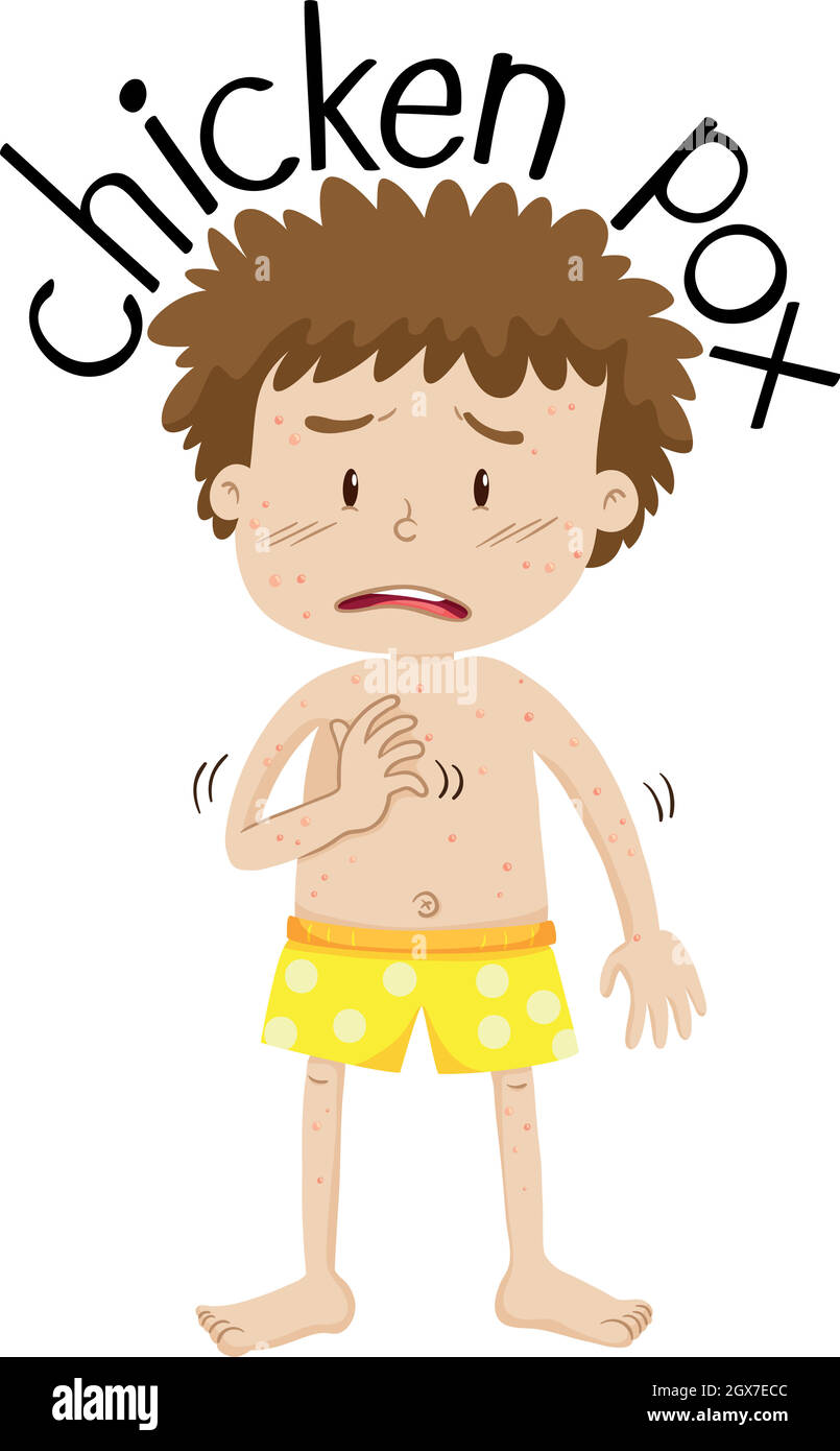 Boy having chicken pox Stock Vector Image & Art - Alamy
