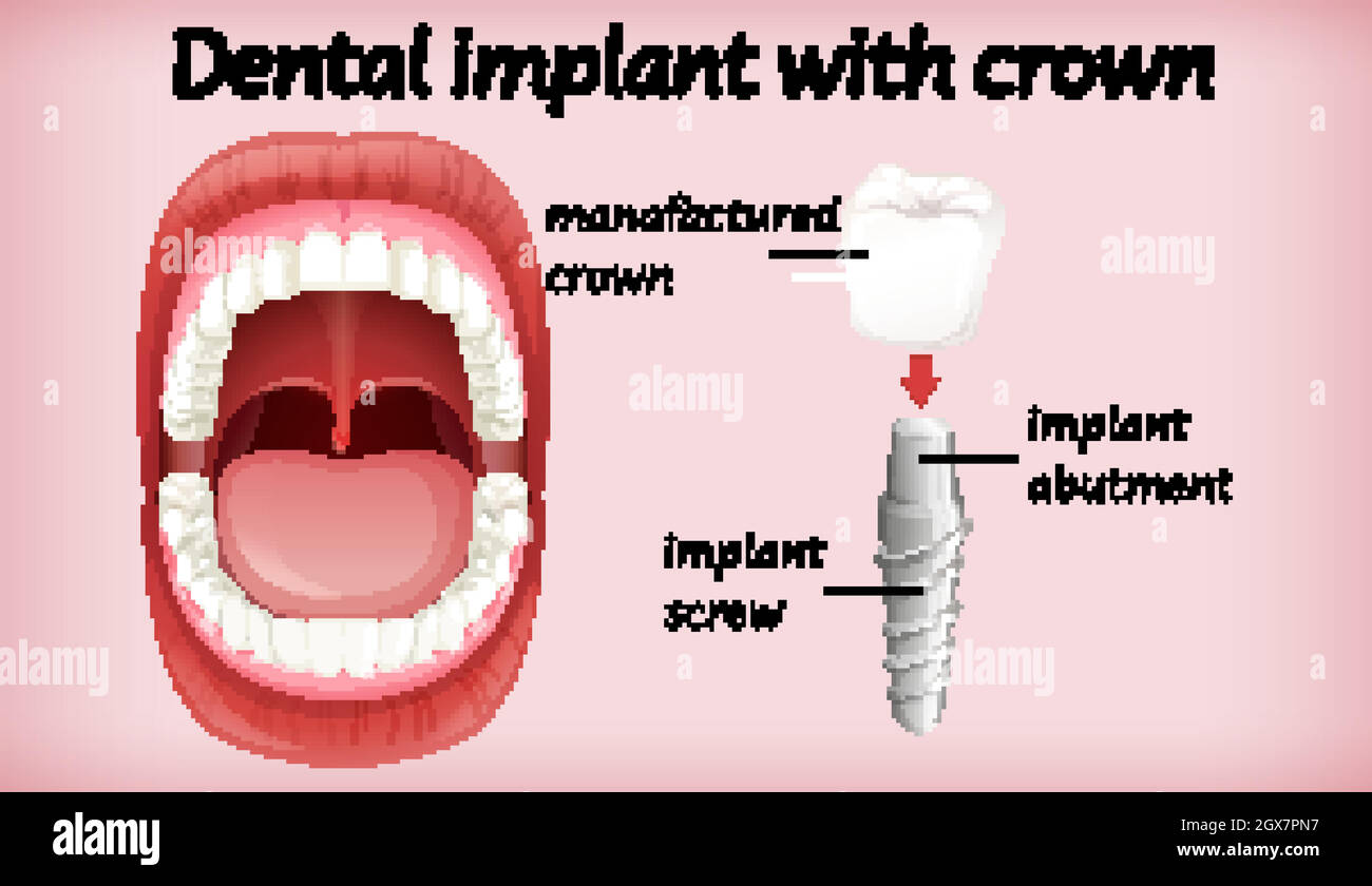 Dental implant with crown Stock Vector Image & Art - Alamy