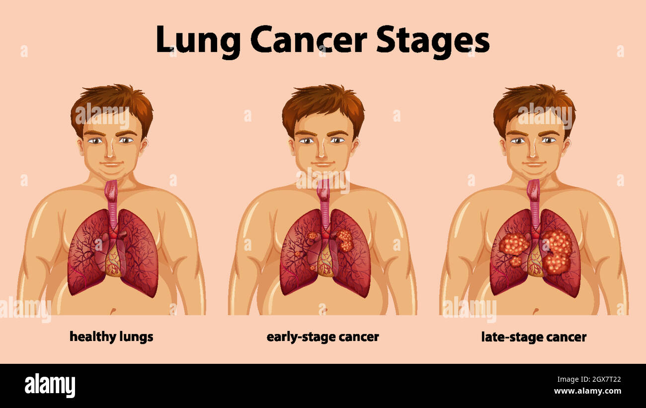 Informative illustration of lung cancer stages Stock Vector Image & Art ...