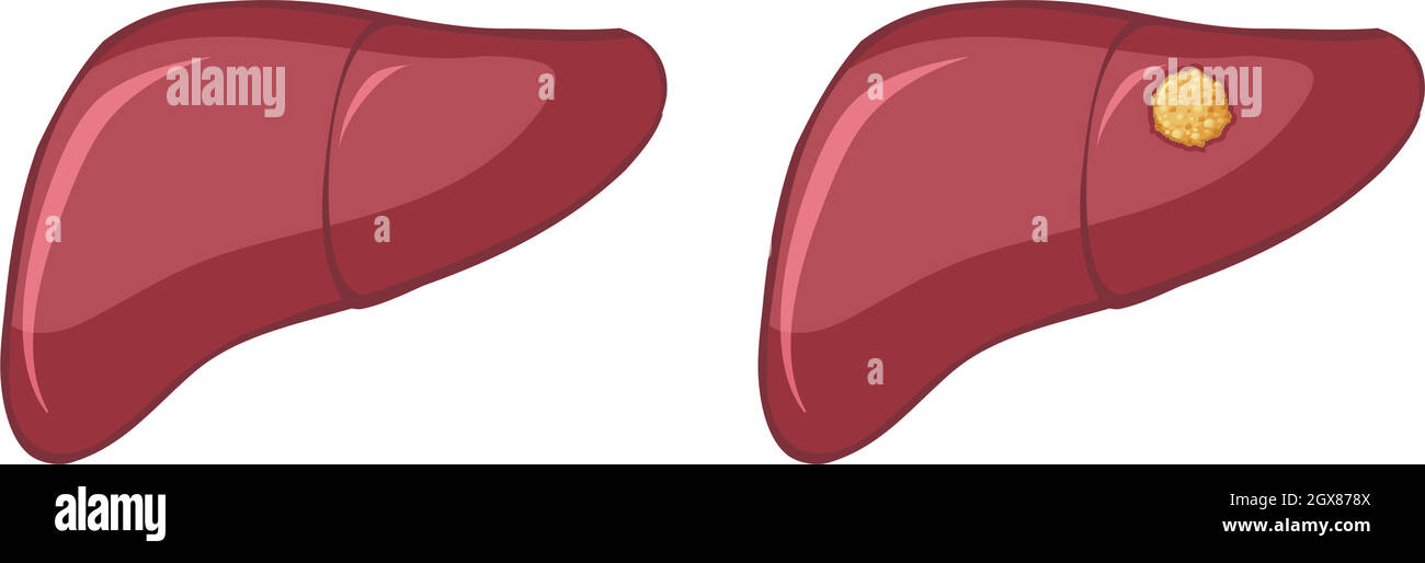 Cancer in human liver on white background Stock Vector Image & Art - Alamy