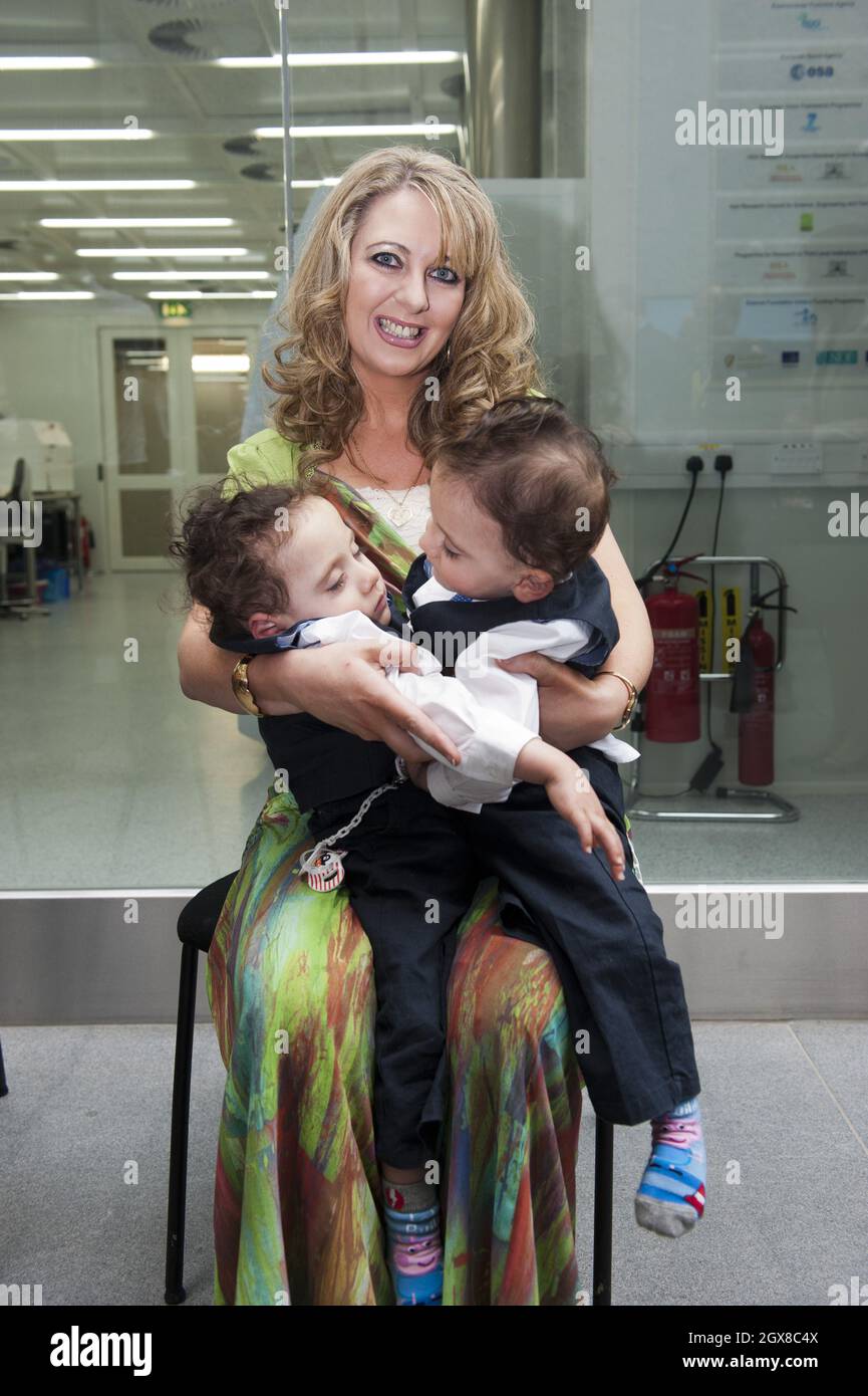 Conjoined twins hi-res stock photography and images - Alamy