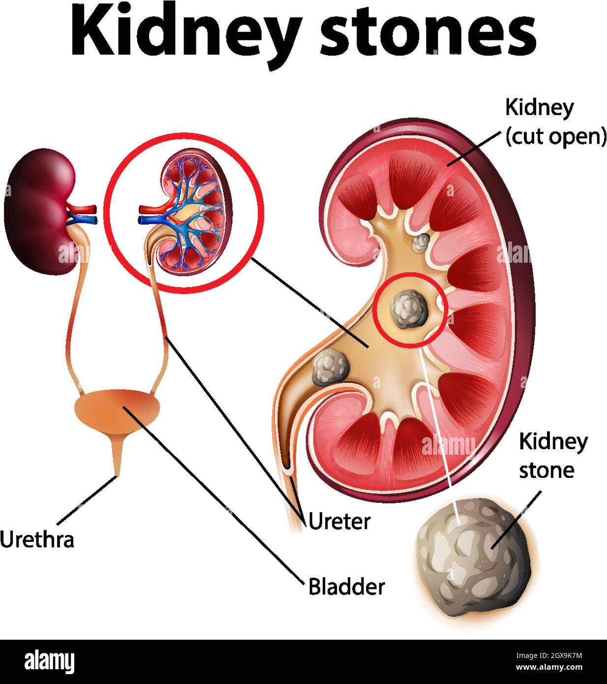 Nephrolith Stock Vector Images - Alamy