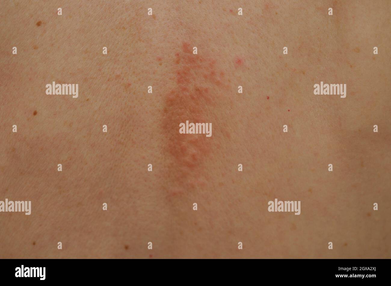 Spots and pimples hi-res stock photography and images - Alamy