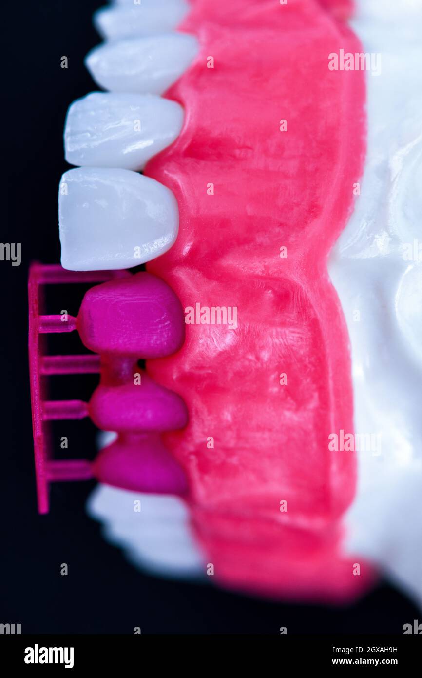 Teeth implant and crown installation process isolated on a black ...