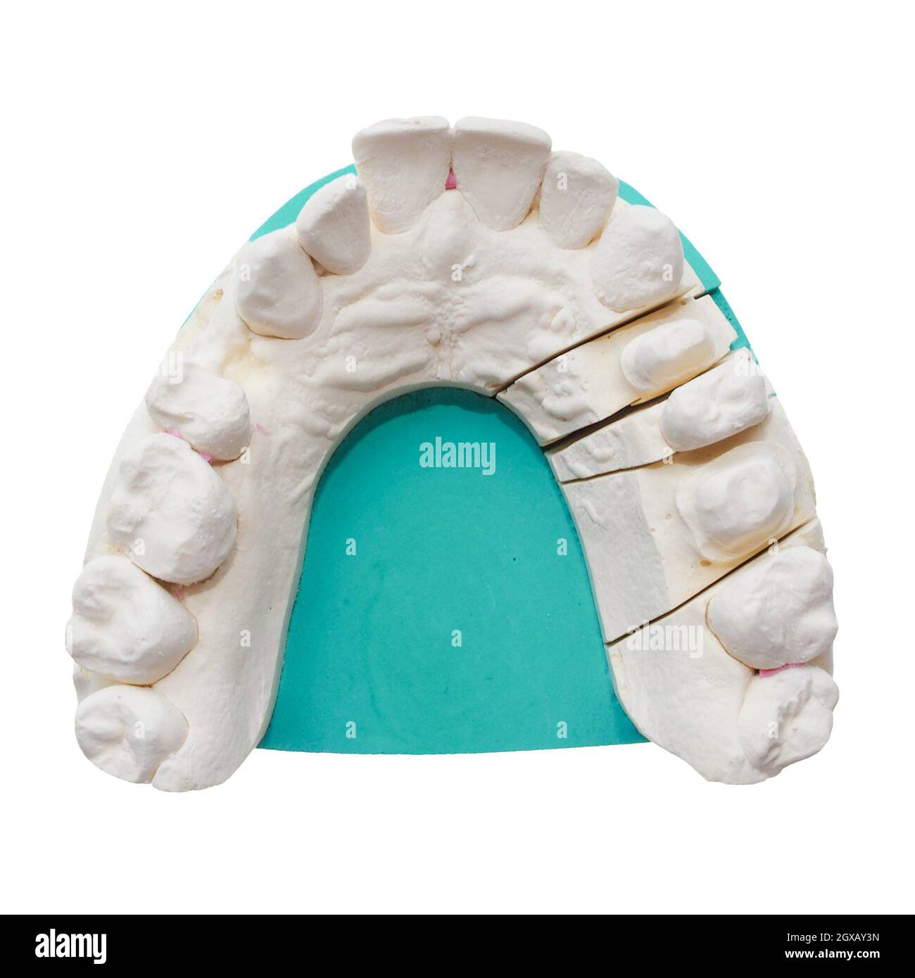 Good Vs Bad Dental Impression at Stephen Featherston blog
