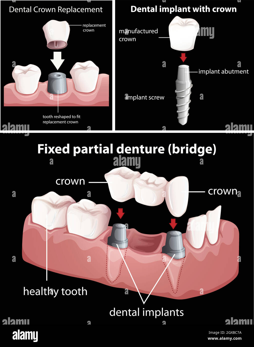 Replacement procedure Stock Vector Images - Alamy