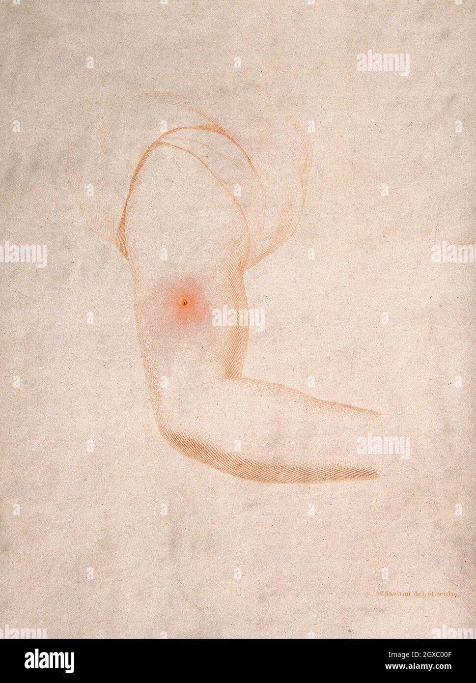 Pustule hi-res stock photography and images - Alamy