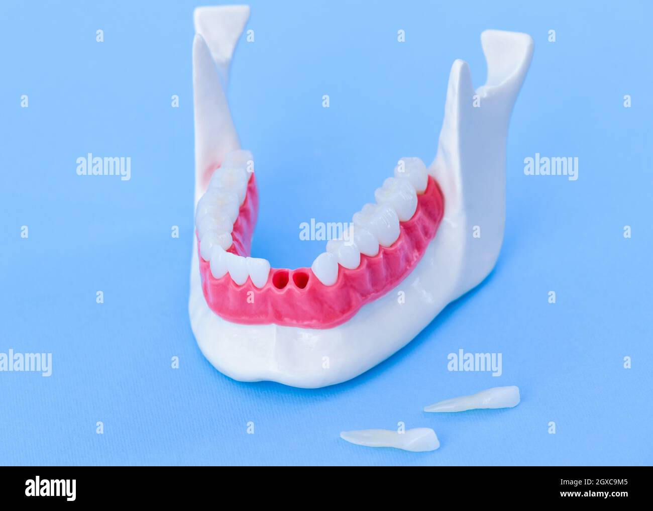 Teeth implant and crown installation process isolated on a blue ...