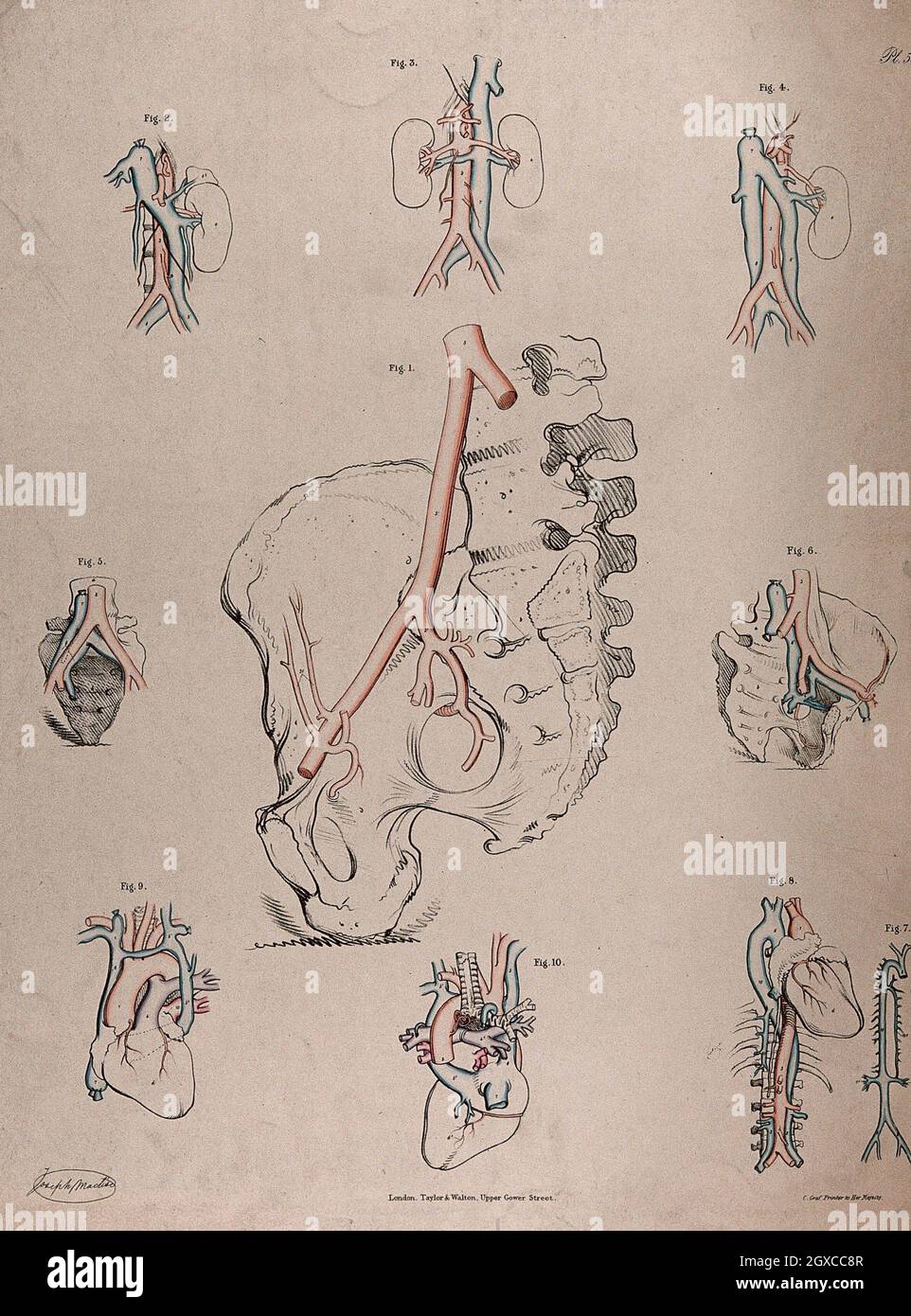 Pelvic Arteries High Resolution Stock Photography and Images - Alamy