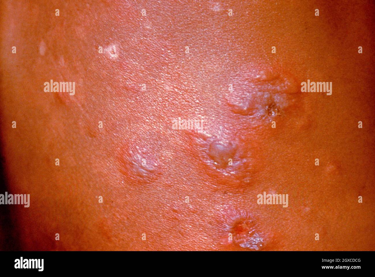 Lepromatous skin lesion hi-res stock photography and images - Alamy