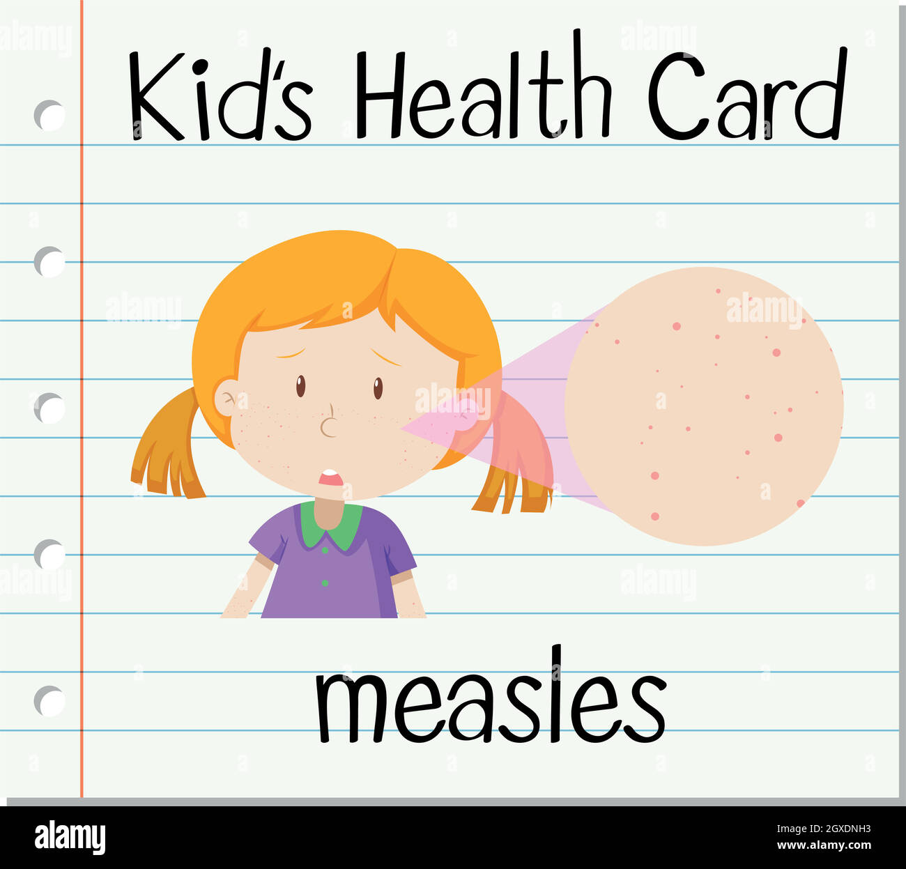 Health card with girl having measles Stock Vector Image & Art - Alamy