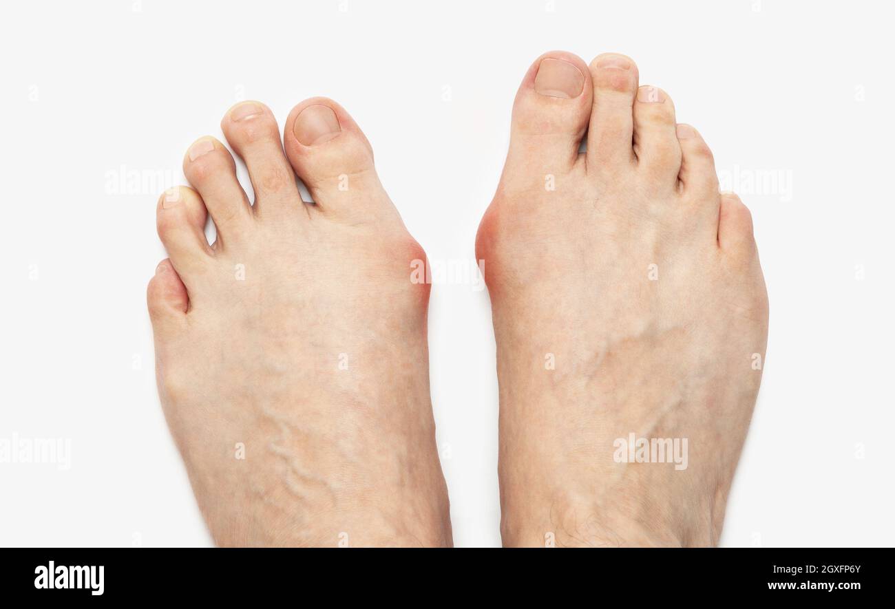 Varus valgus and Hallux valgus, bunion on white background. With ...