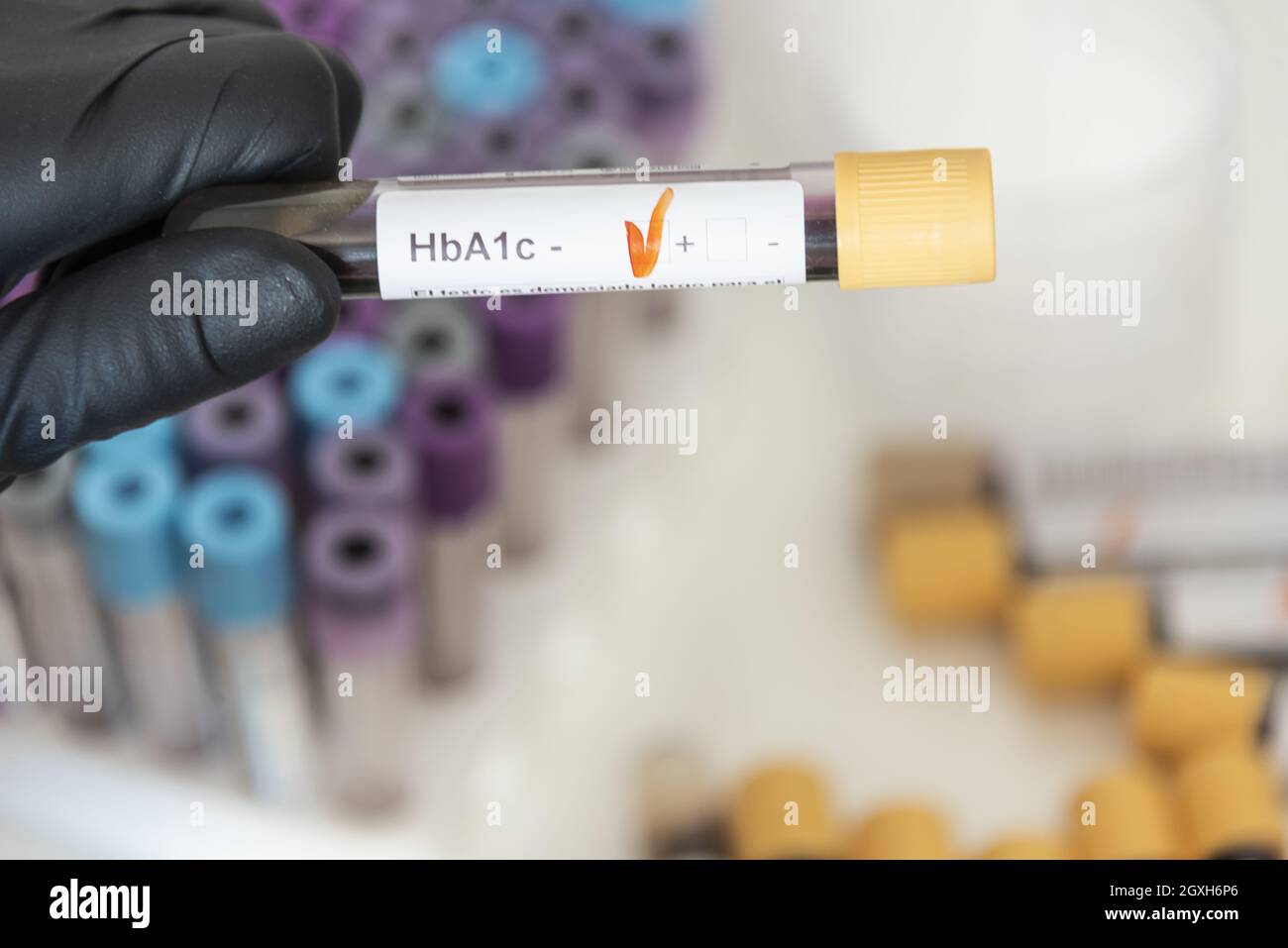 Close-up of positive blood sample from hBA1c diabetes Stock Photo - Alamy