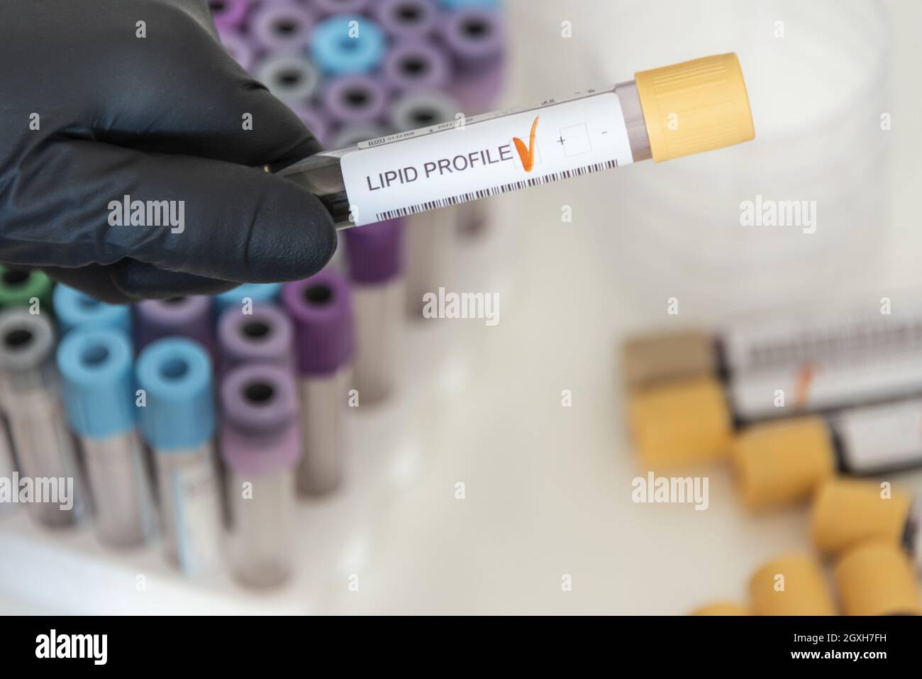 Lipid profile hi-res stock photography and images - Alamy