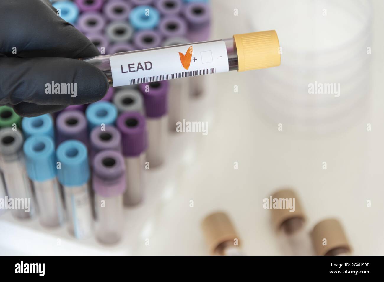 Close-up of positive blood sample from lead Stock Photo - Alamy