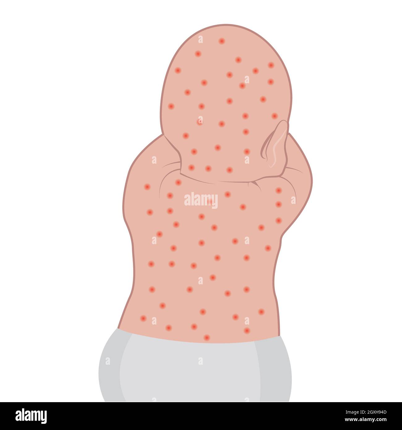 Baby's back affected with eczema skin disease vector illustration ...