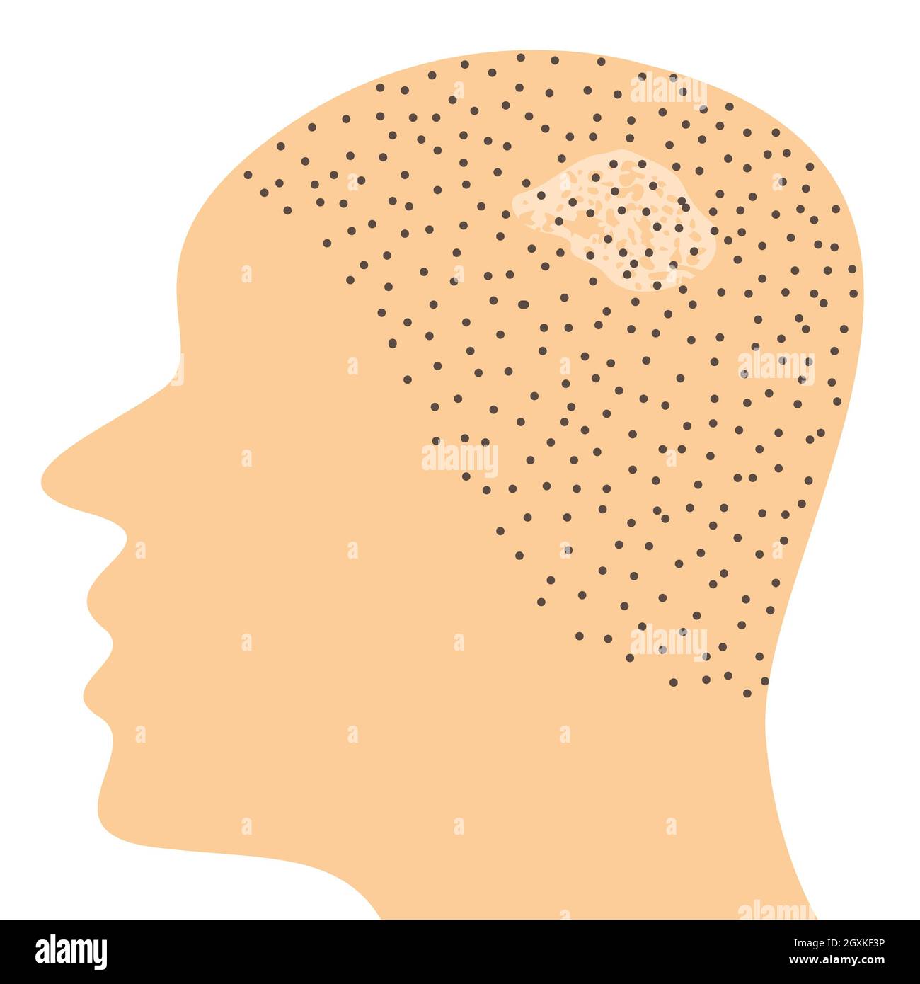 Fungal infection on scalp head vector illustration Stock Photo - Alamy