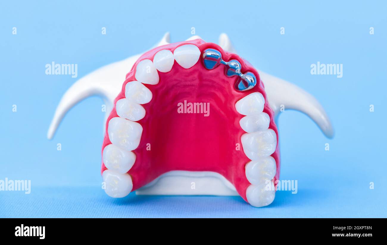 Teeth implant and crown installation process isolated on a blue ...