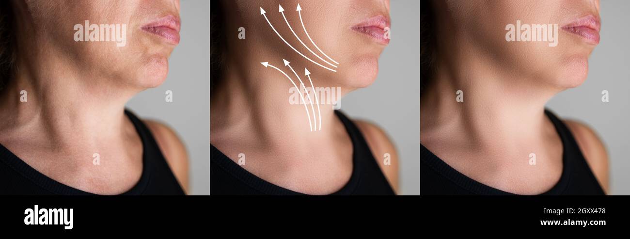 Double Chin Face Injection And Plastic Surgery Stock Photo - Alamy