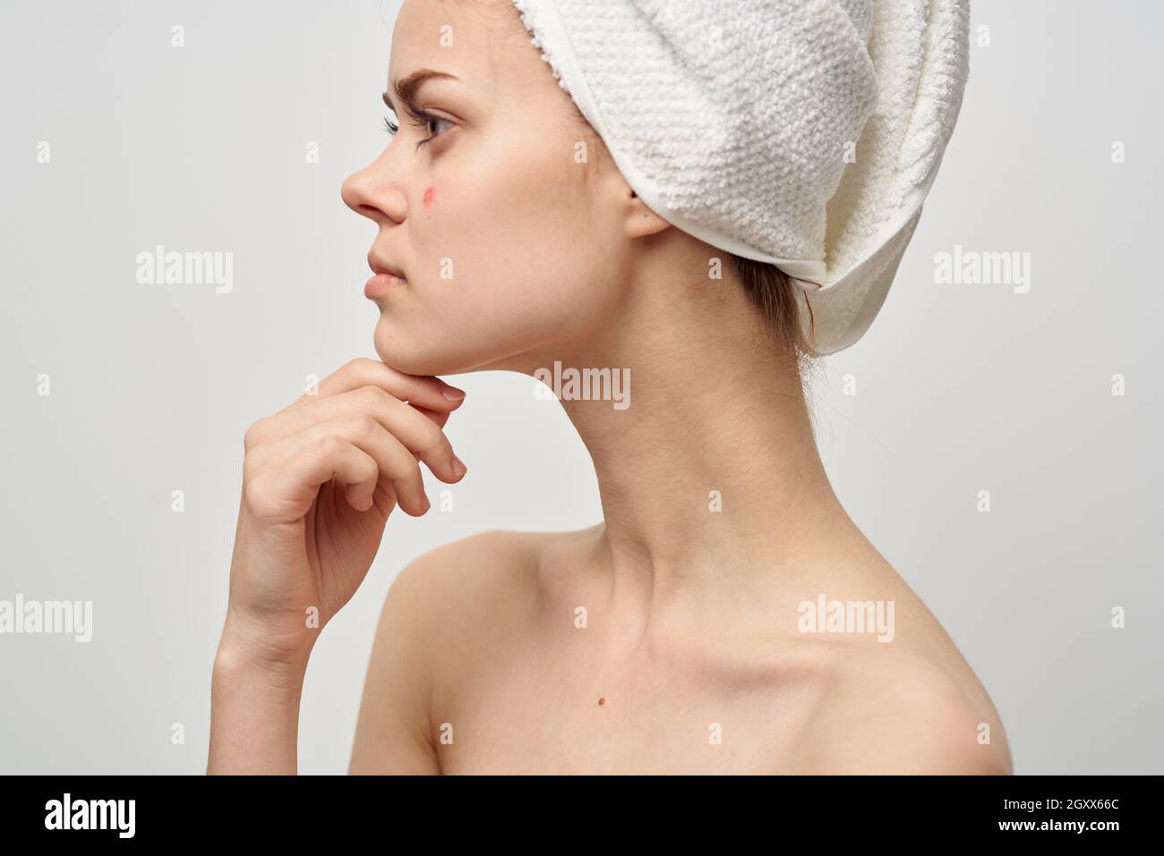 woman with a pimple on the face skin problems close-up Stock Photo - Alamy