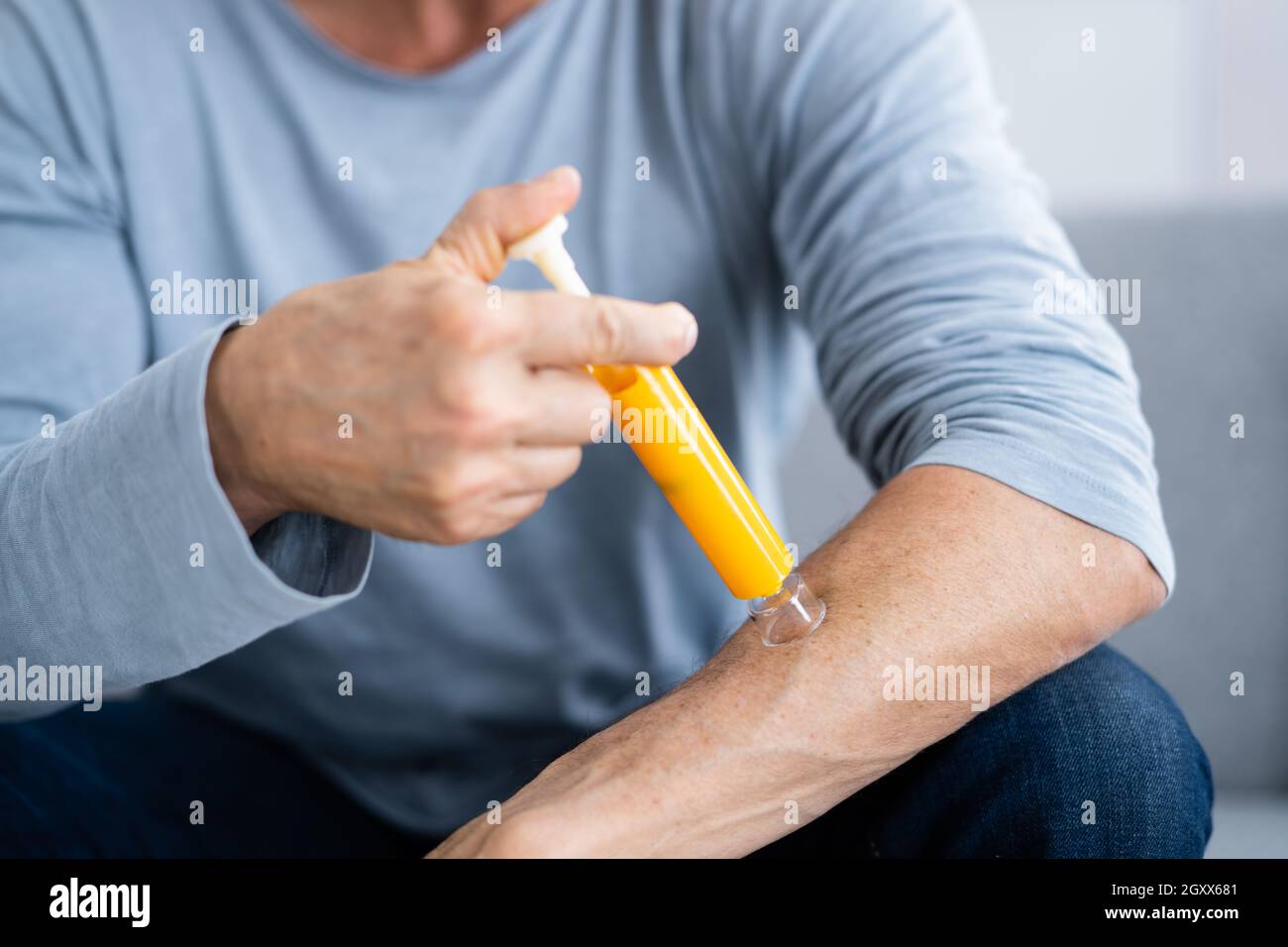 Bug Bite Suction Tool And Venom Extractor Stock Photo - Alamy