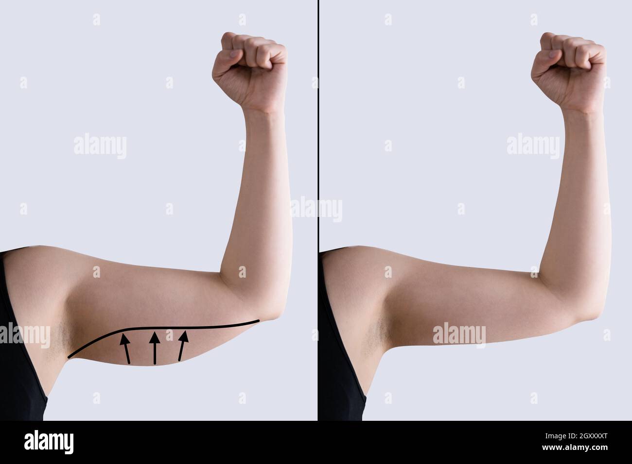 Before And After Arm Cellulite Surgery And Liposuction. Showing Results ...