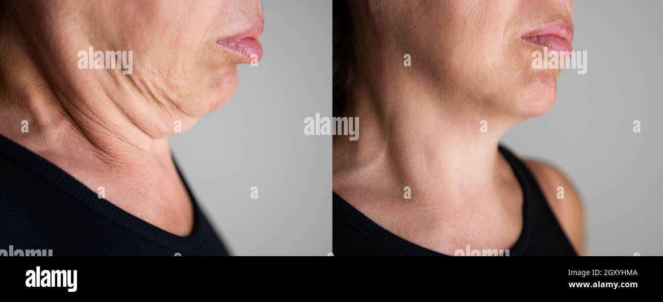 Double Chin Face Injection And Plastic Surgery Stock Photo - Alamy