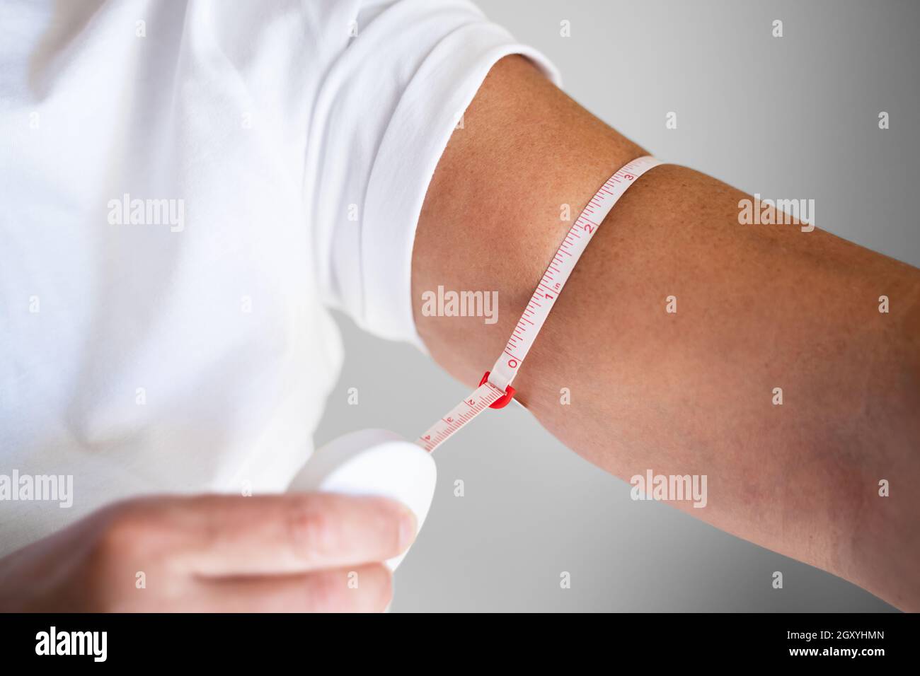Overweight Female Arm Cellulite Measure Before Surgery Stock Photo - Alamy