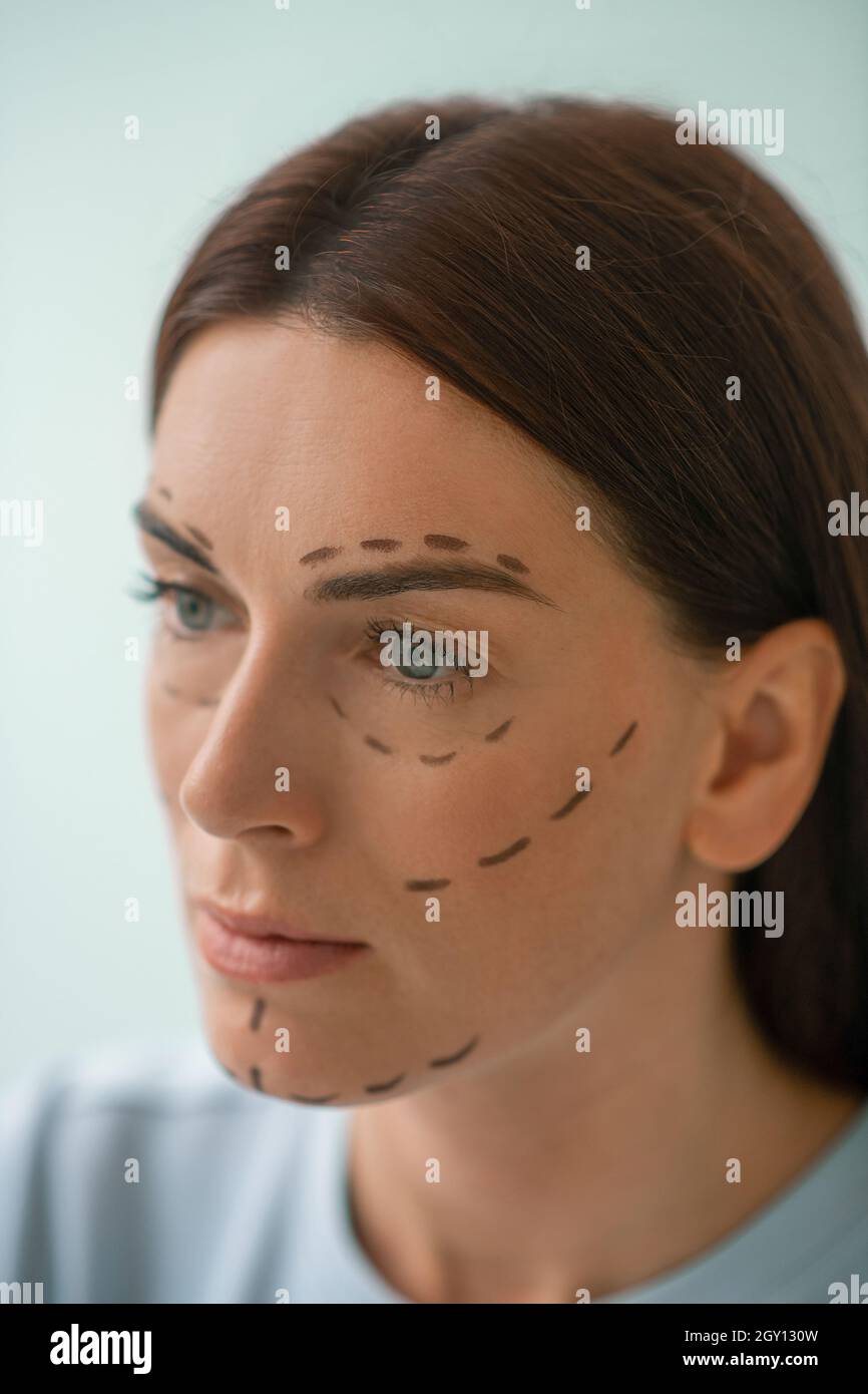 Woman plastic surgery face lines hi-res stock photography and images ...